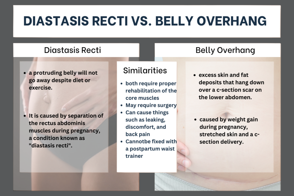 How To Reduce A C Section Belly Overhang Naturally [no More Hiding]
