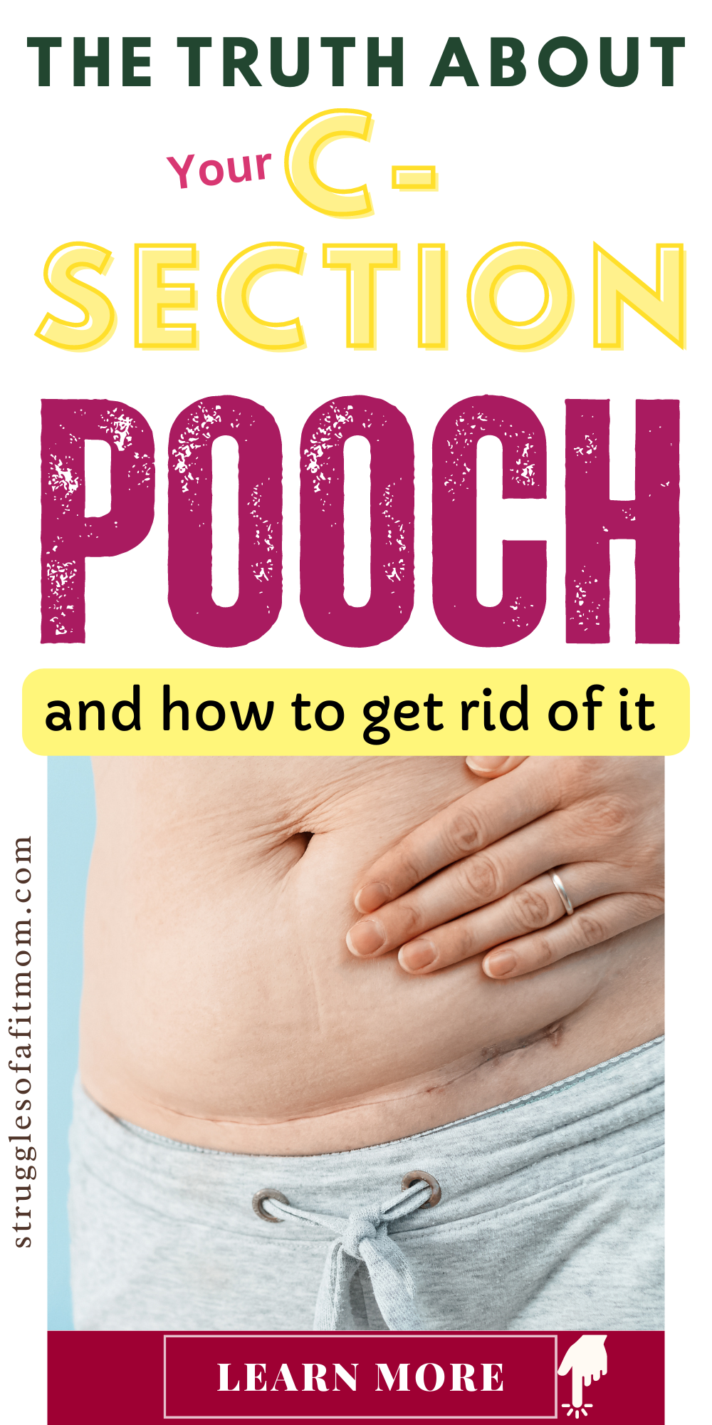 How To Reduce A C Section Belly Overhang Naturally [no More Hiding]